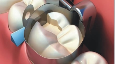 **MATRIX BAND AND RETAINERS